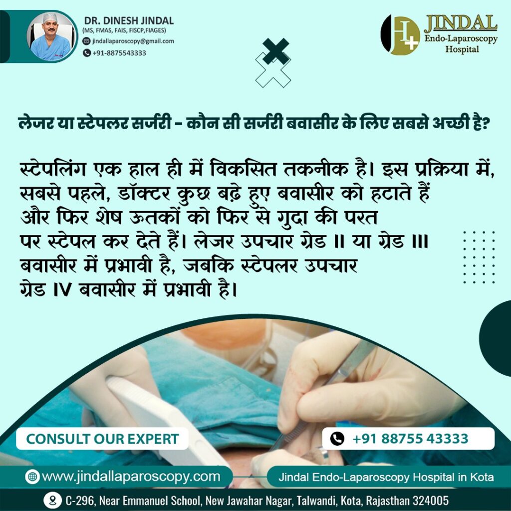 Laser or Stapler Surgery - Which Surgery is Best for Piles